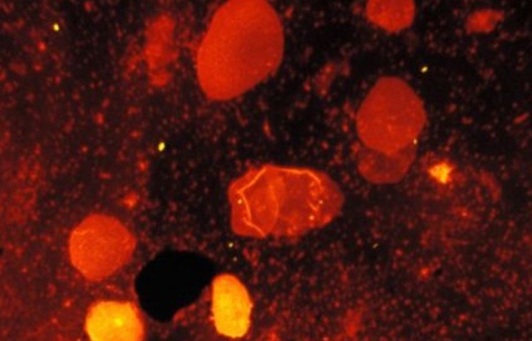 TB outbreak at Omaha daycare prompts public health emergency